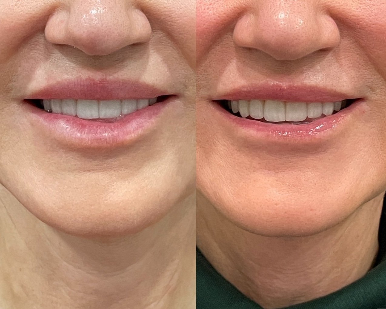 إذابة الفيلر – Horizons Medical Care